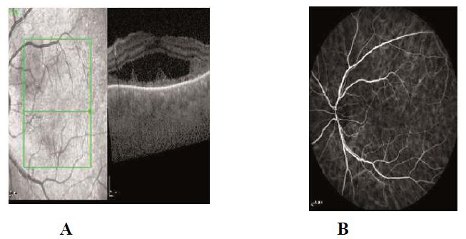 OPHTALMIE SYMPATHIQUE: A PROPOS DE DEUX CAS – Bulletin Médical d’Owendo